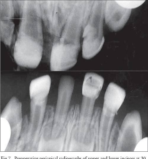 Figure 3 from Dentinogenesis imperfecta: an early treatment strategy ...