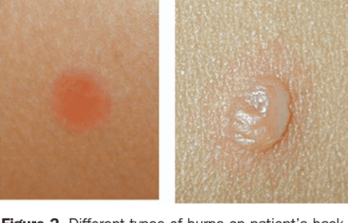 Figure 2 from Images in emergency medicine. Child abuse caused by ...