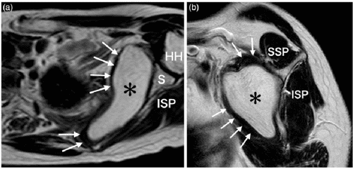 Figure 2 from Lipoma in the subscapularis muscle causing scapular ...