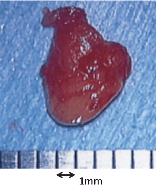 Figure 4 from A Case of a Child with a Lipoma of the Middle Ear and a ...