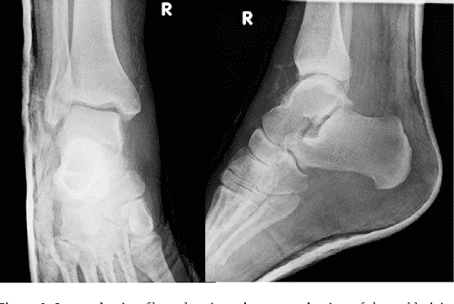 Figure 1 from Closed posterior ankle dislocation without associated ...