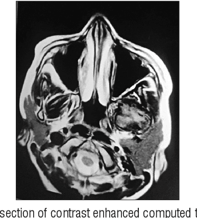 Figure 4 from Embryonal Rhabdomyosarcoma of External Ear - A Rare Case ...