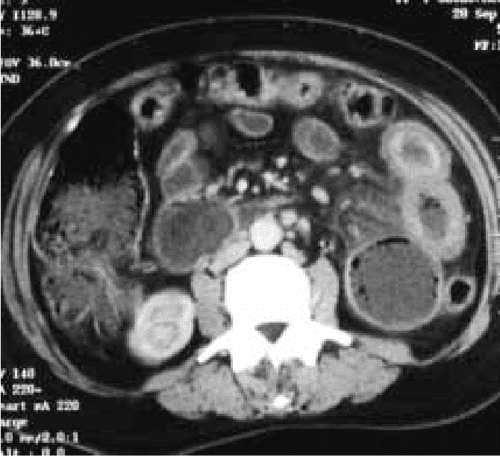 Figure 2 from Hémoglobinurie paroxystique nocturne avec ischémie ...