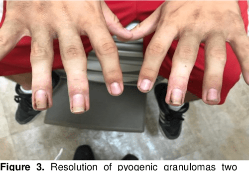 Figure 2 from Isotretinoin induced nail fold pyogenic granuloma ...