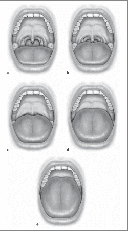 Updated Friedman Staging System for Obstructive Sleep Apnea. | Semantic ...