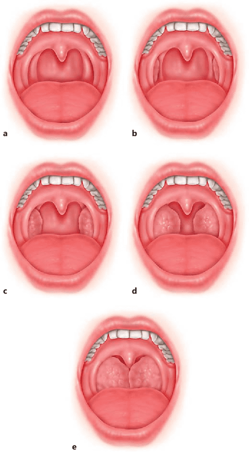 Updated Friedman Staging System for Obstructive Sleep Apnea. | Semantic ...