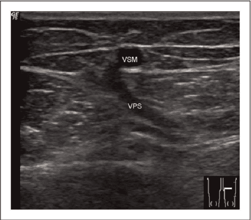 figure-1-from-the-venous-perforators-of-the-lower-limb-a-new