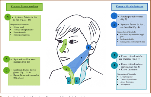Figure 13 from Kystes et fistules congénitaux de la face et du cou. Pré ...
