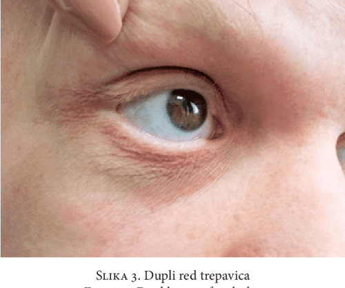 Figure 3 from LYMPHEDEMA-DISTICHIASIS SYNDROME – A CASE REPORT ...