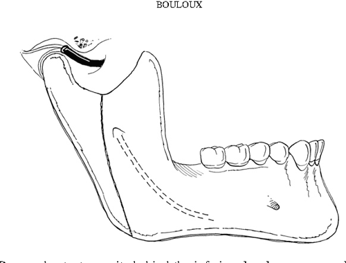Figure 9 from Modified condylotomy for temporomandibular joint ...