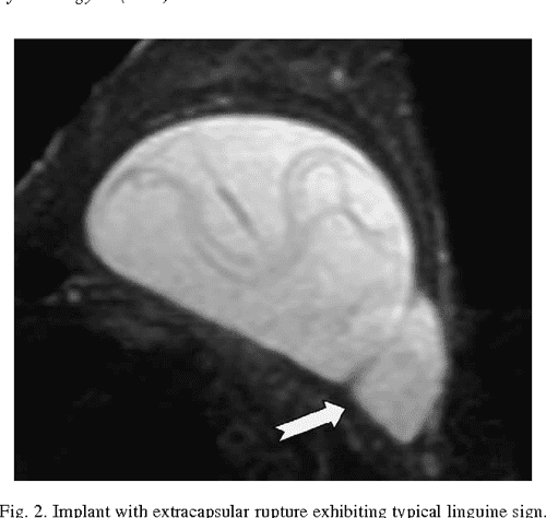 Figure 9 from The diagnosis of breast implant rupture: MRI findings ...