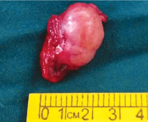Figure 2 From Lymphoepithelial Cyst Of Tonsil Semantic Scholar