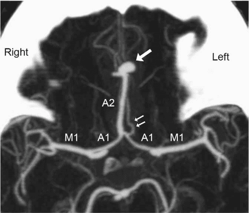 Figure 2 from Microneurosurgical management of aneurysms at A3 segment ...