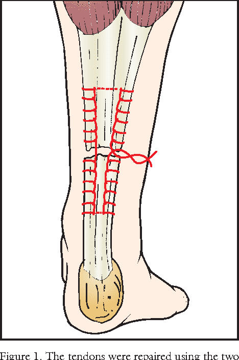 Figure 1 from AN IN VITRO BIOMECHANICAL COMPARISON OF ACHILLES TENDON ...