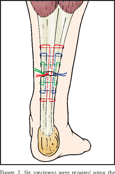 Figure 1 from AN IN VITRO BIOMECHANICAL COMPARISON OF ACHILLES TENDON ...