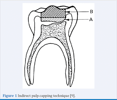 Figure 1 from Indirect and Direct Pulp Capping: Reactionary vs ...