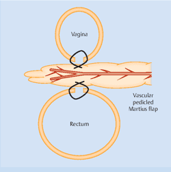 [PDF] Surgical Approach for Repair of Rectovaginal Fistula by Modified ...