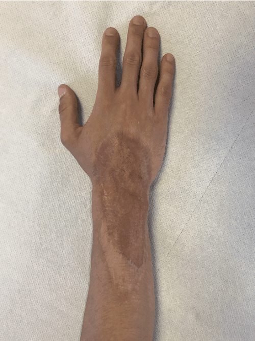 Figure 2 from The use of dermal regeneration template (Pelnac®) in a ...