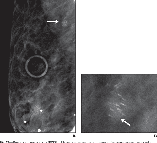 Breast calcifications: the focal group. | Semantic Scholar