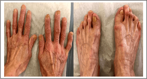 Figure 2 from A case report of resolution of acrokeratosis ...