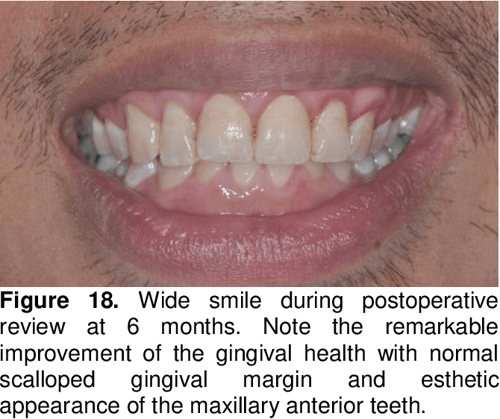 Figure 2 from Esthetic Management of Gummy Smile with Maxillary Bone ...