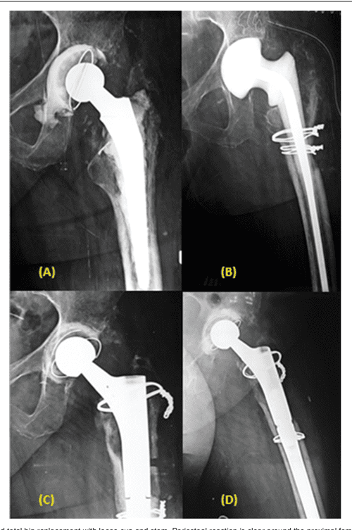 Table 1 from Single-stage versus two-stage revision of total hip ...