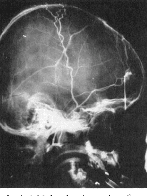 Figure 1 from Superficial temporal artery aneurysms. | Semantic Scholar