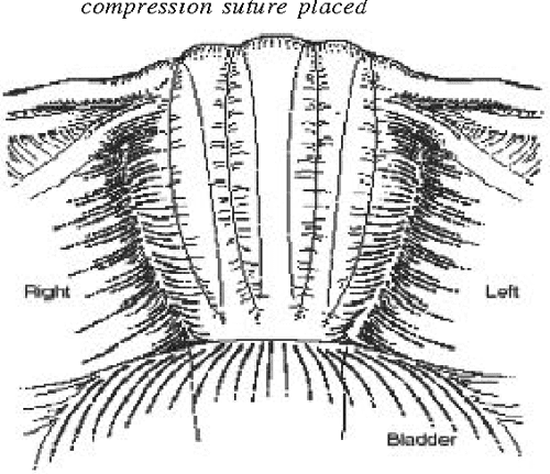 Figure 6 from Role of Modified B-lynch Suture in Modern Day Management ...