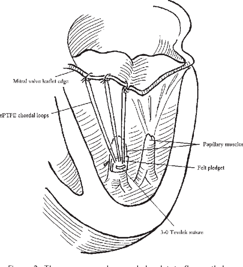 Figure 1 from Simplified placement of multiple artificial mitral valve ...