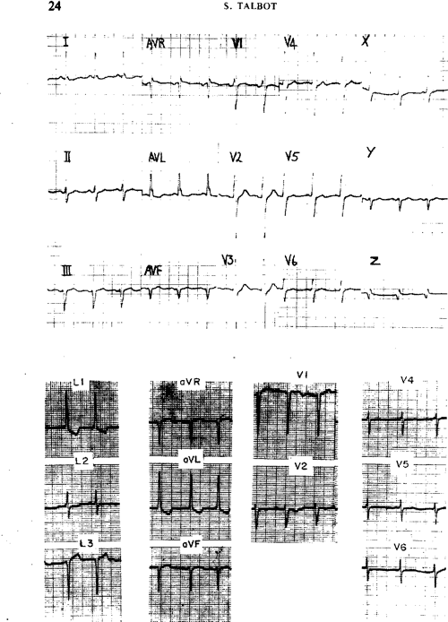 Figure 2 from Diagnosis of Ventricular Conduction Defects | Semantic ...
