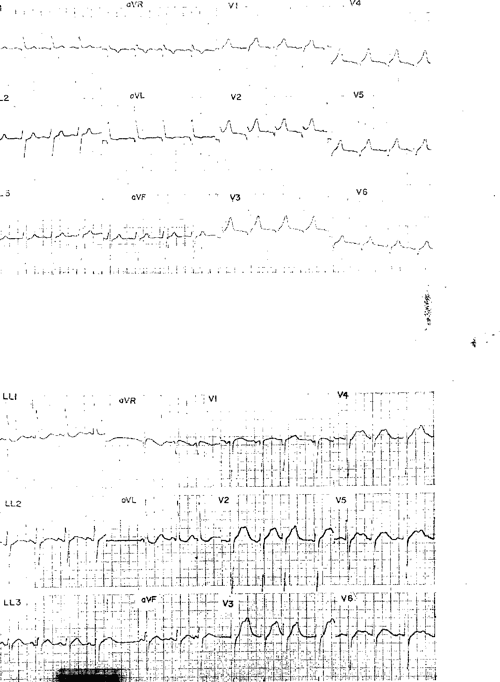 Figure 2 from Diagnosis of Ventricular Conduction Defects | Semantic ...