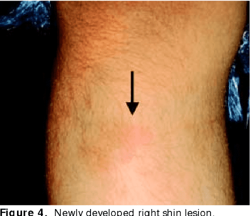 Figure 4 from Subcutaneous granuloma annulare presented as multiple ...