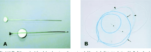 Figure 1 from Self-Securing Monocanalicular Stent for Treatment of ...