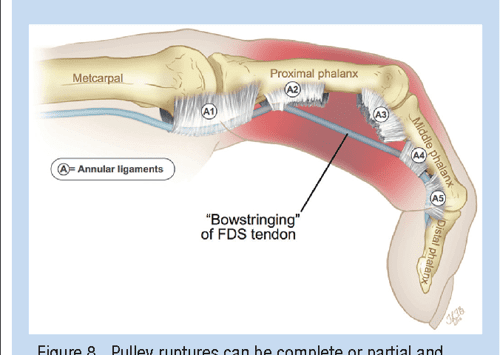 Jam Injuries of the Finger | Semantic Scholar