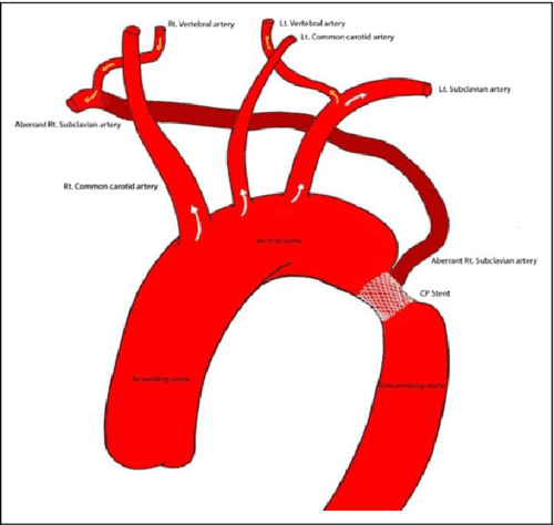Figure 3 From Be Aware Of Aberrant Right Subclavian Artery Origin