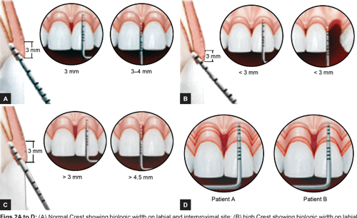 [PDF] Biologic Width : An Important Link between Periodontics and ...