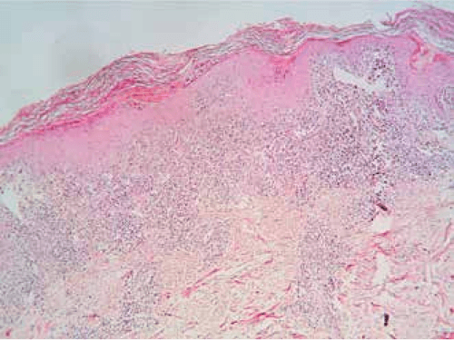Figure 3 from Lichen planus-lupus erythematosus overlap syndrome ...