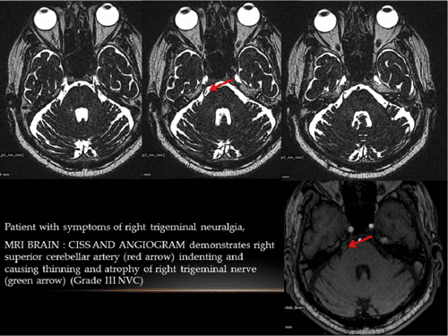Imaging in neurovascular conflict of the trigeminal nerve with grading ...