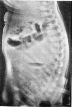 Sternal malformation/vascular dysplasia or PHACES syndrome? | Semantic ...