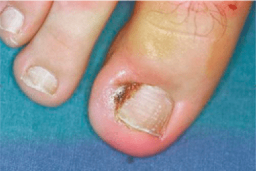 Figure 3 from Comparison of Phenol and Sodium Hydroxide Chemical ...