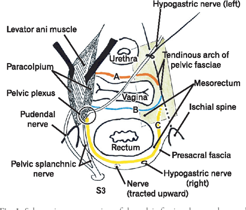 Figure 1 from Nerves and fasciae in and around the paracolpium or ...