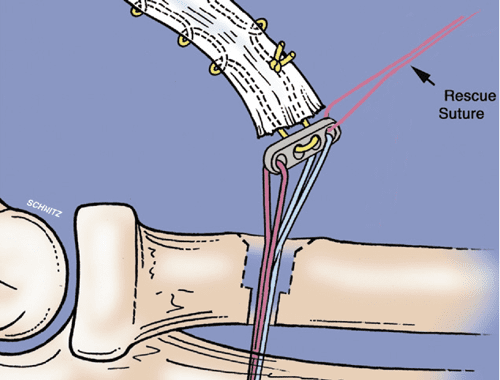 Figure 4 from Endobutton repair of distal biceps tendon ruptures ...