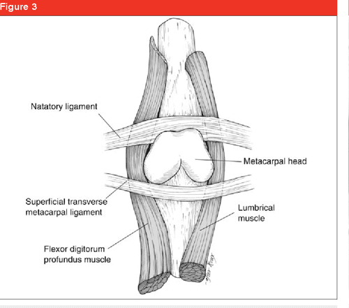 Figure 1 from Metacarpophalangeal Joint Dislocation | Semantic Scholar