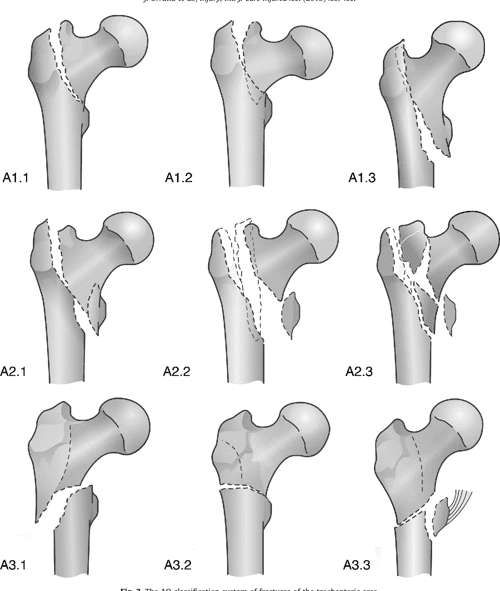 Figure 1 from Do thoraco-lumbar spinal injuries classification systems ...