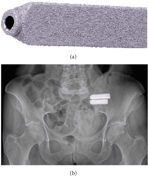 [PDF] Implant-bone interface of sacroiliac joint fusion using iFuse ...
