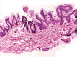 Figure 2 from Berardinelli-Seip syndrome in a 6-year-old boy ...