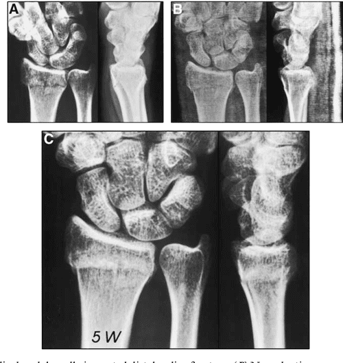 Figure 2 from Closed manipulation and casting of distal radius ...