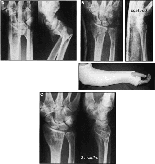 Figure 2 from Closed manipulation and casting of distal radius ...