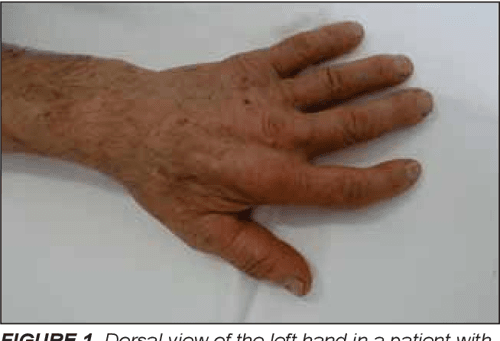 [PDF] Split hand syndrome and the split hand index in ALS patients ...