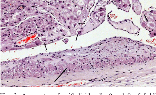 Figure 3 from Perivascular epithelioid cell tumor (PEComa) of the cheek ...